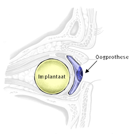 Operatieve verwijdering van het oog | Het Oogziekenhuis Rotterdam